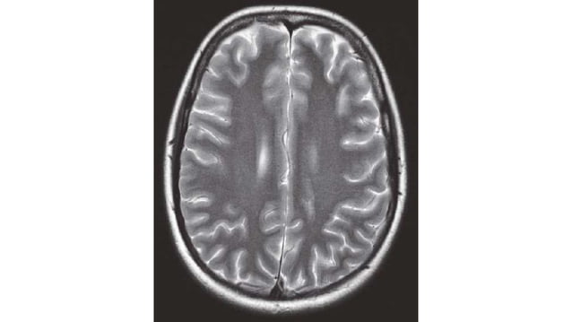 Surgical landmarks and sectional anatomy in neurosurgery | PPT