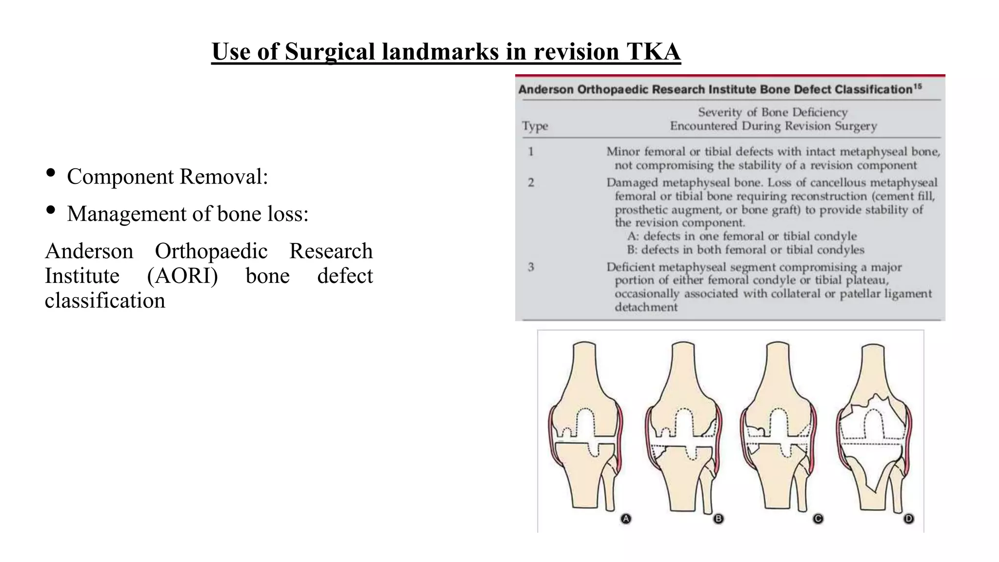Surgical landmarks in revision total knee | PPT