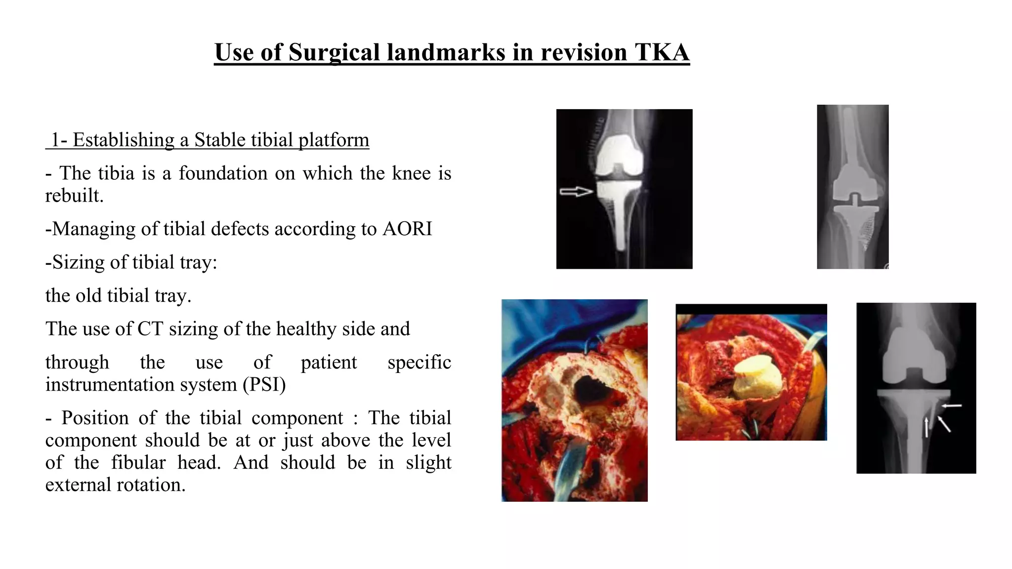 Surgical landmarks in revision total knee | PPTX