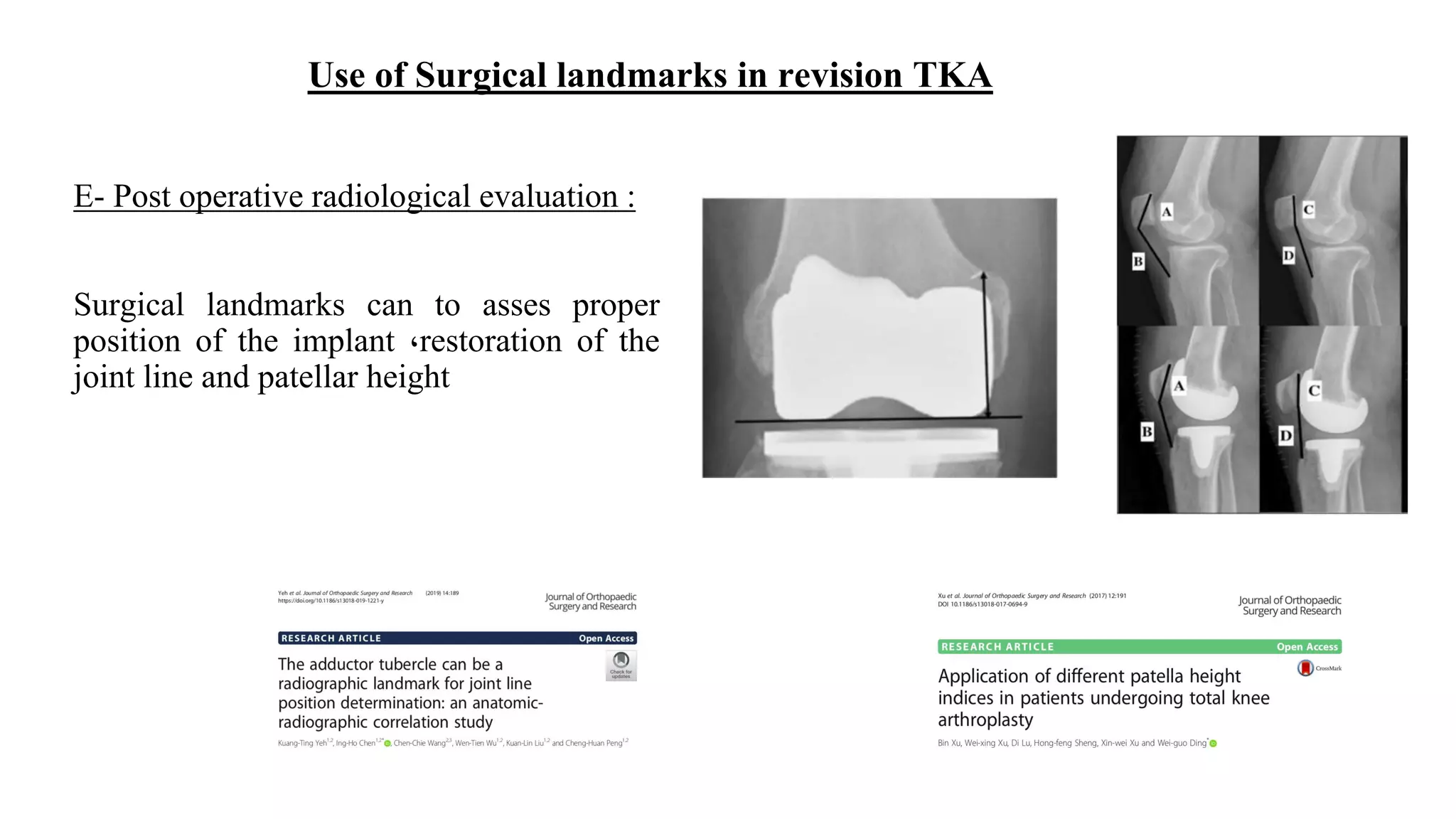 Surgical landmarks in revision total knee | PPT