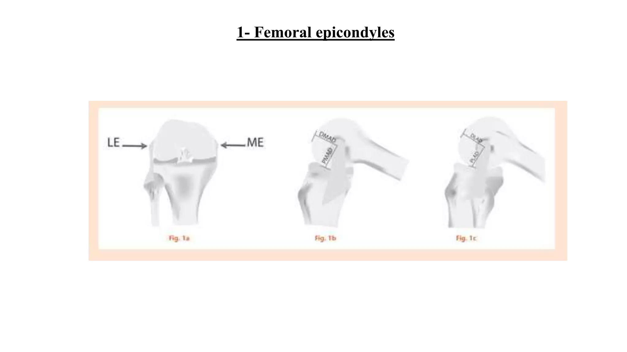 Surgical landmarks in revision total knee | PPT