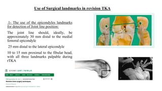 Surgical landmarks in revision total knee | PPT