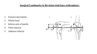 Surgical landmarks in revision total knee | PPTX