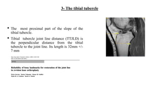 Surgical landmarks in revision total knee | PPTX