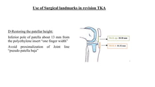 Surgical landmarks in revision total knee | PPT
