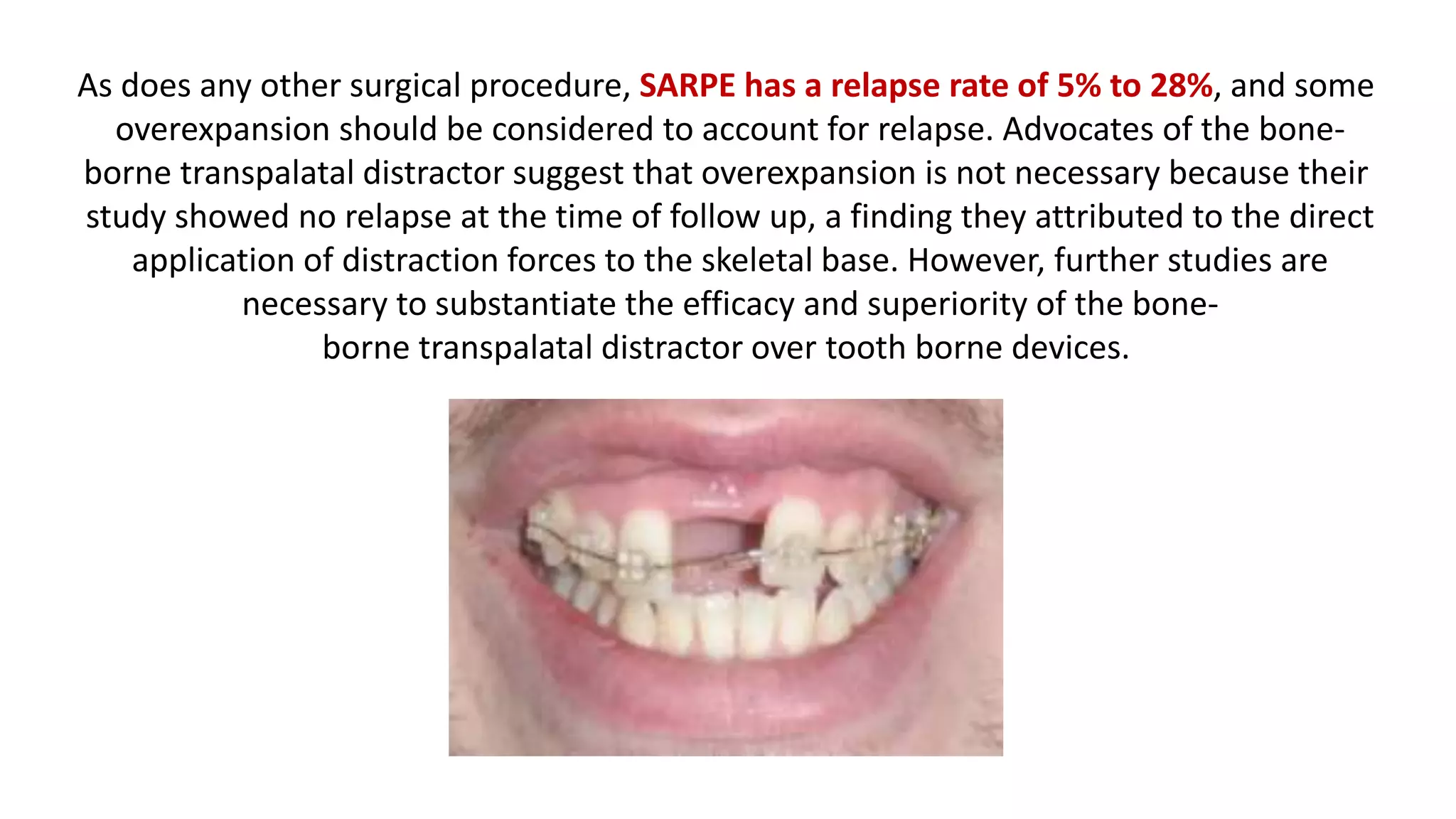 Surgically Assisted Rapid Palatal Expansion (SARPE) | PPTX
