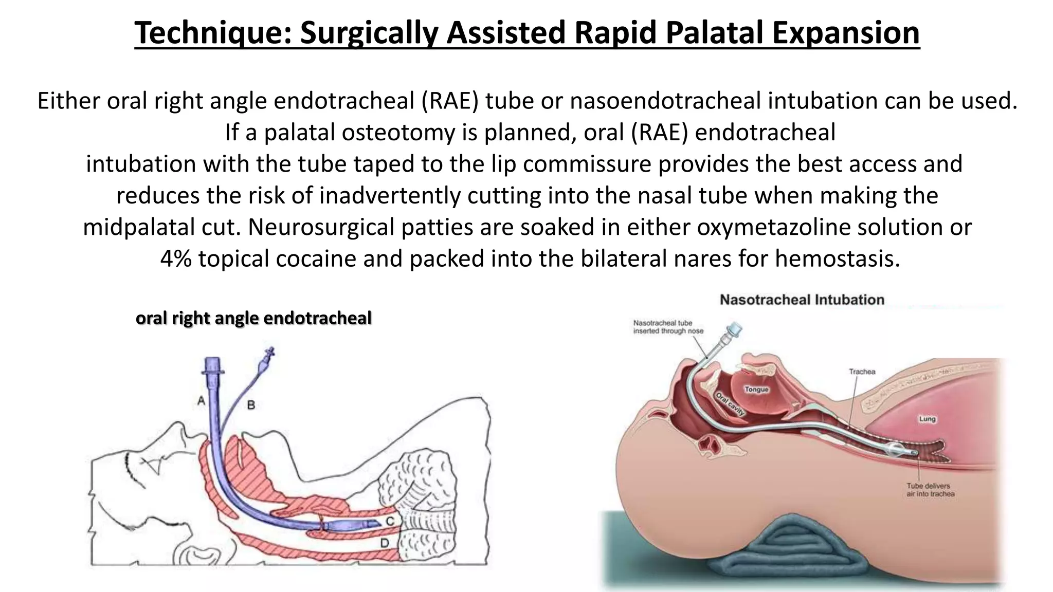 Surgically Assisted Rapid Palatal Expansion (SARPE) | PPTX