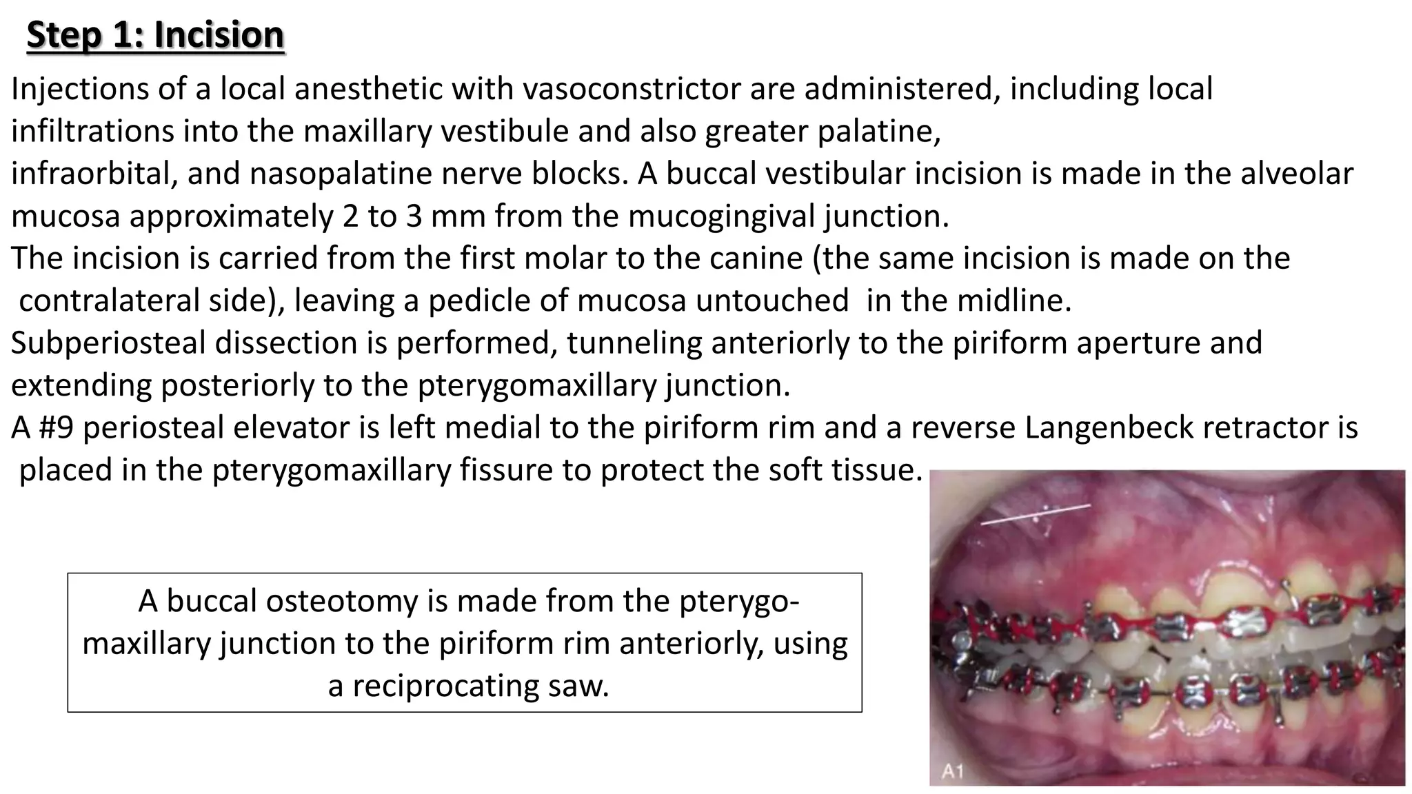 Surgically Assisted Rapid Palatal Expansion (SARPE) | PPTX
