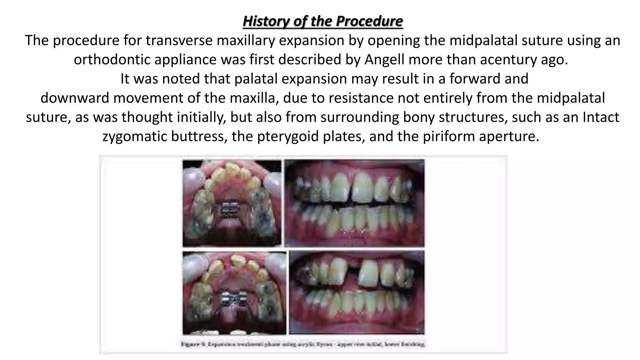 Surgically Assisted Rapid Palatal Expansion (SARPE) | PPTX