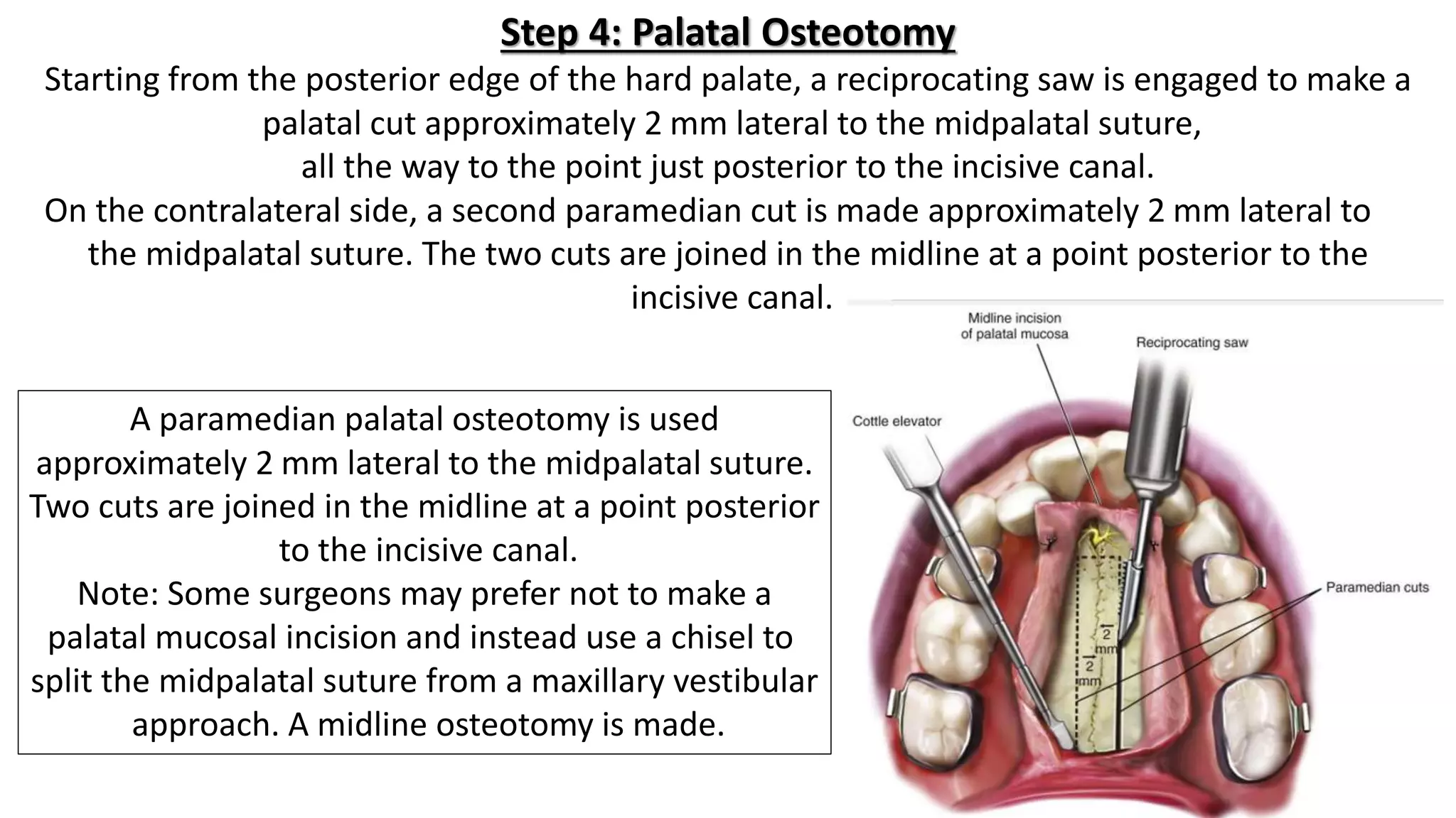Surgically Assisted Rapid Palatal Expansion (SARPE) | PPTX