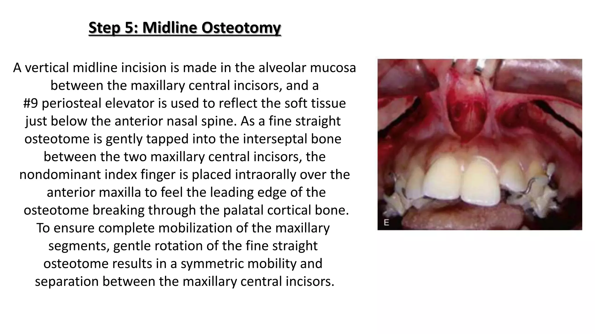 Surgically Assisted Rapid Palatal Expansion (SARPE) | PPTX