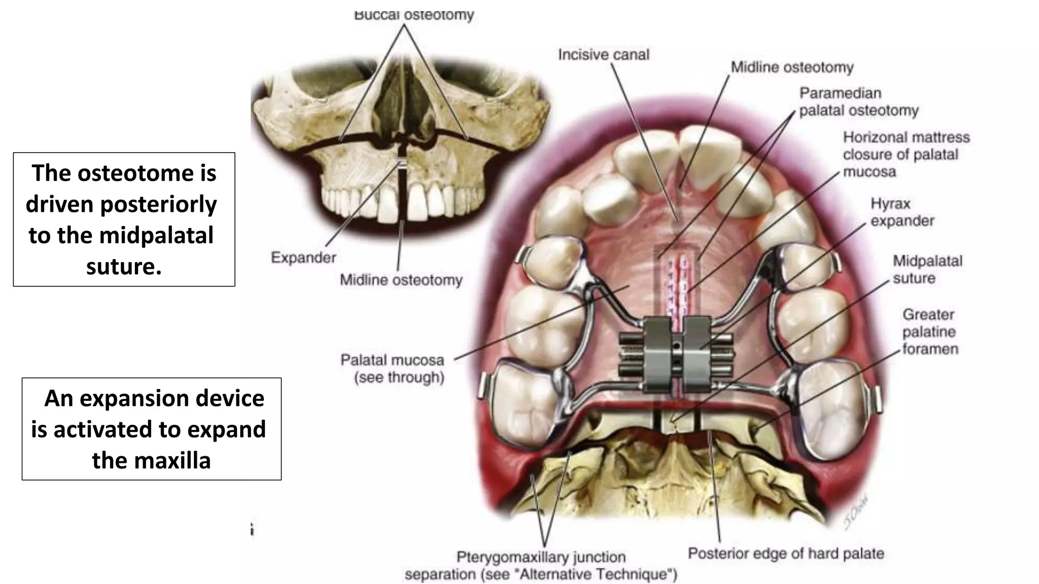 Surgically Assisted Rapid Palatal Expansion (SARPE) | PPTX