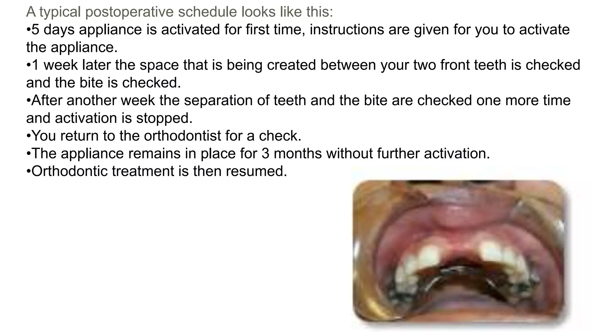 Surgically Assisted Rapid Palatal Expansion (SARPE) | PPTX