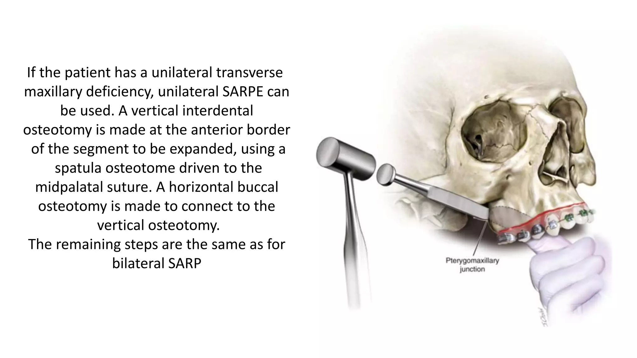 Surgically Assisted Rapid Palatal Expansion (SARPE) | PPTX