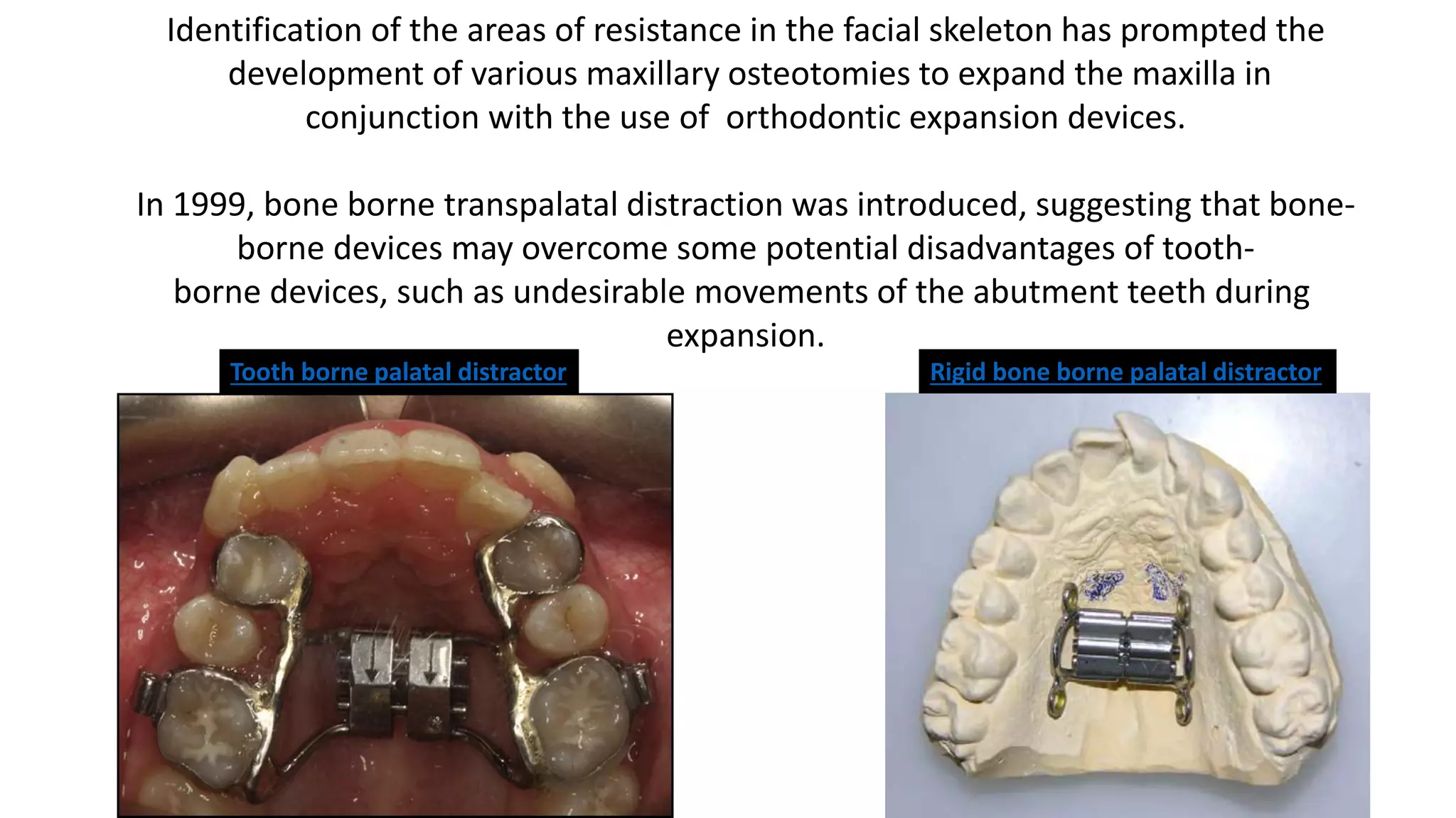 Surgically Assisted Rapid Palatal Expansion (SARPE) | PPTX