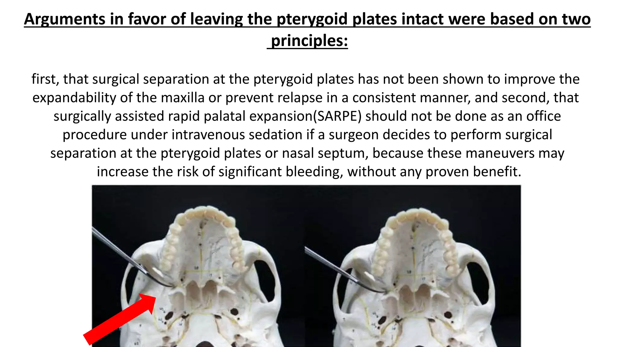 Surgically Assisted Rapid Palatal Expansion (SARPE) | PPTX