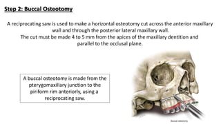 Surgically Assisted Rapid Palatal Expansion (SARPE) | PPTX