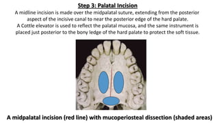 Surgically Assisted Rapid Palatal Expansion (SARPE) | PPTX
