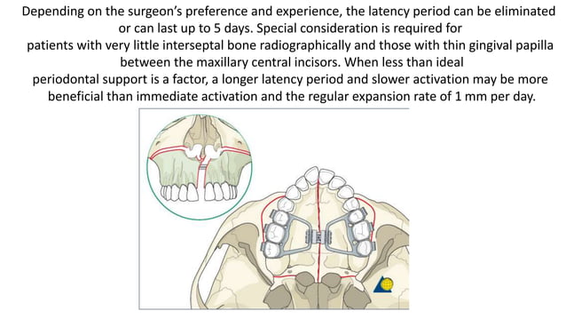 Surgically Assisted Rapid Palatal Expansion (SARPE) | PPTX