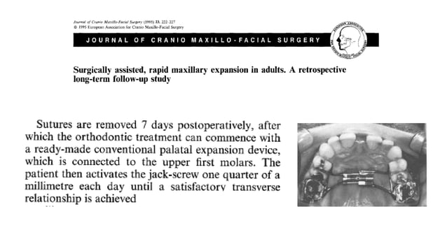 Surgically Assisted Rapid Palatal Expansion (SARPE) | PPTX