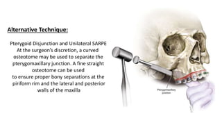 Surgically Assisted Rapid Palatal Expansion (SARPE) | PPTX