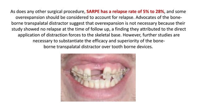 Surgically Assisted Rapid Palatal Expansion (SARPE)
