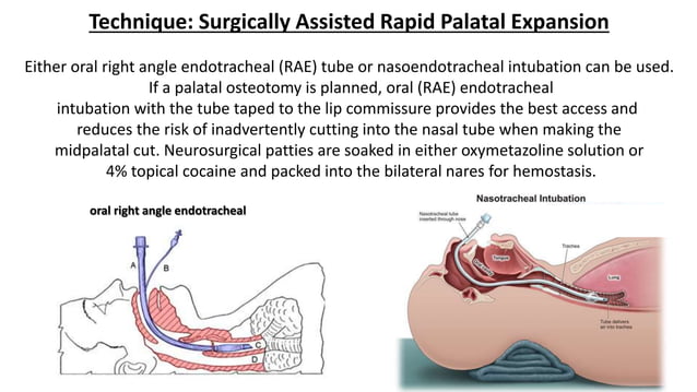 Surgically Assisted Rapid Palatal Expansion (SARPE)