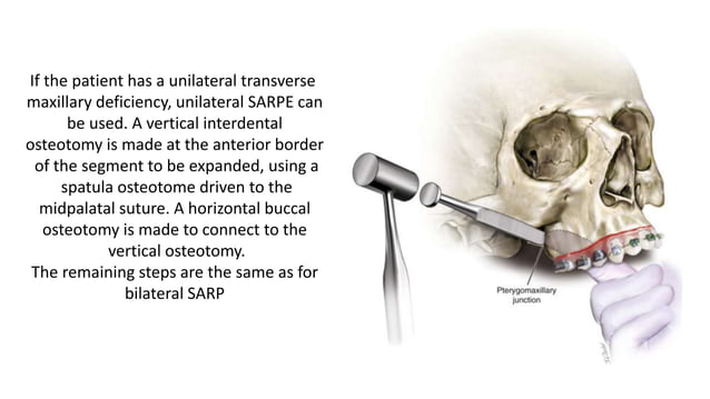 Surgically Assisted Rapid Palatal Expansion (SARPE)