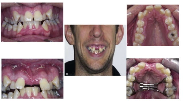 Surgically Assisted Rapid Palatal Expansion (SARPE)