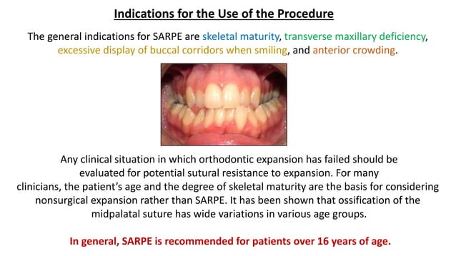 Surgically Assisted Rapid Palatal Expansion (SARPE)
