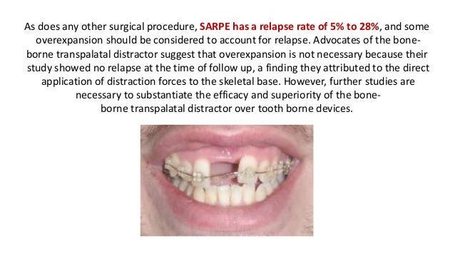 Surgically Assisted Rapid Palatal Expansion (SARPE)