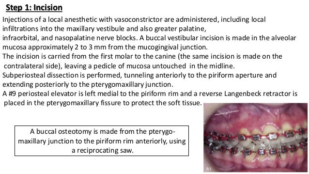 Surgically Assisted Rapid Palatal Expansion (SARPE)