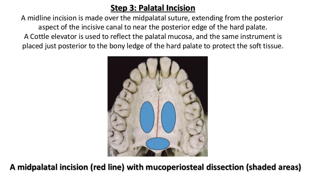 Surgically Assisted Rapid Palatal Expansion (SARPE)