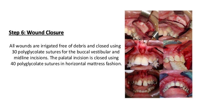 Surgically Assisted Rapid Palatal Expansion (SARPE)
