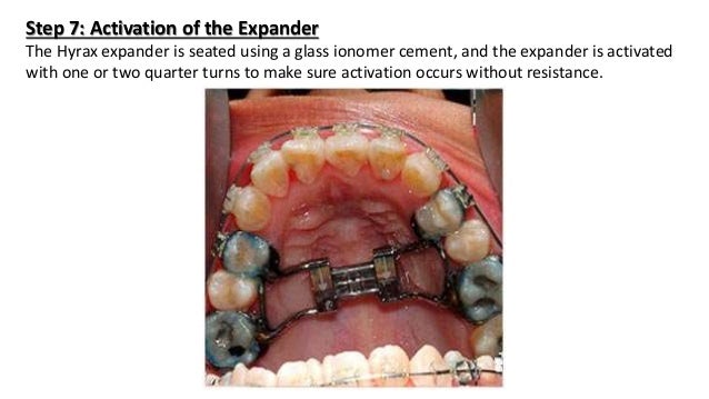 Surgically Assisted Rapid Palatal Expansion (SARPE)