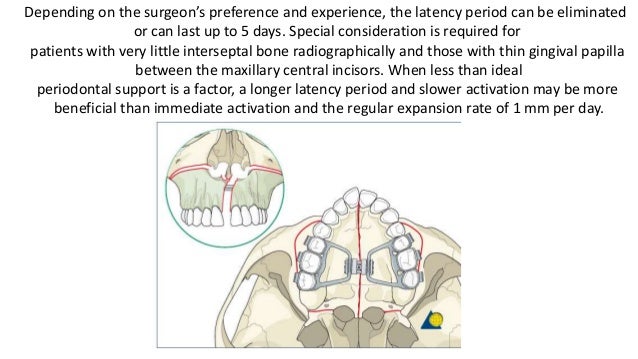 Surgically Assisted Rapid Palatal Expansion (SARPE)