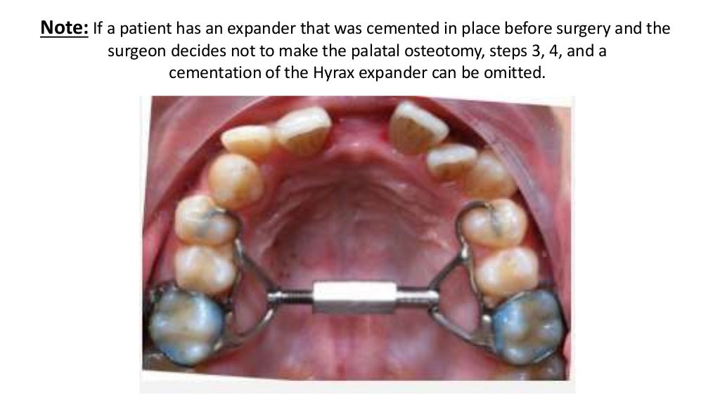 Surgically Assisted Rapid Palatal Expansion (SARPE)