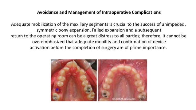 Surgically Assisted Rapid Palatal Expansion (SARPE)