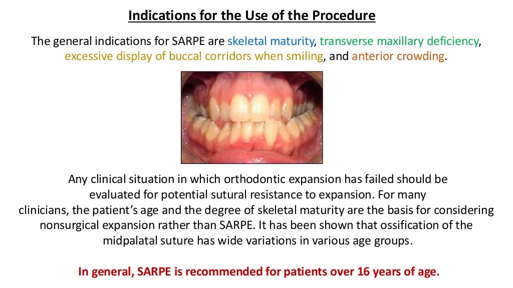 Surgically Assisted Rapid Palatal Expansion (SARPE)