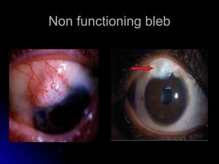 Surgically induced glaucoma | PPT