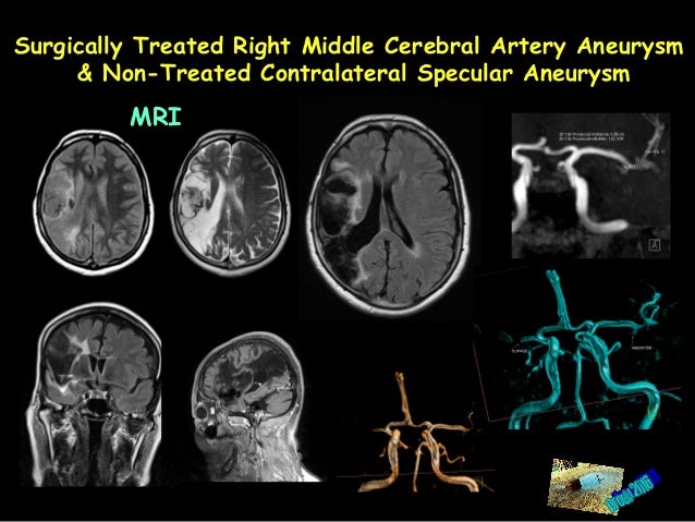 Middle Cerebral Artery Mri