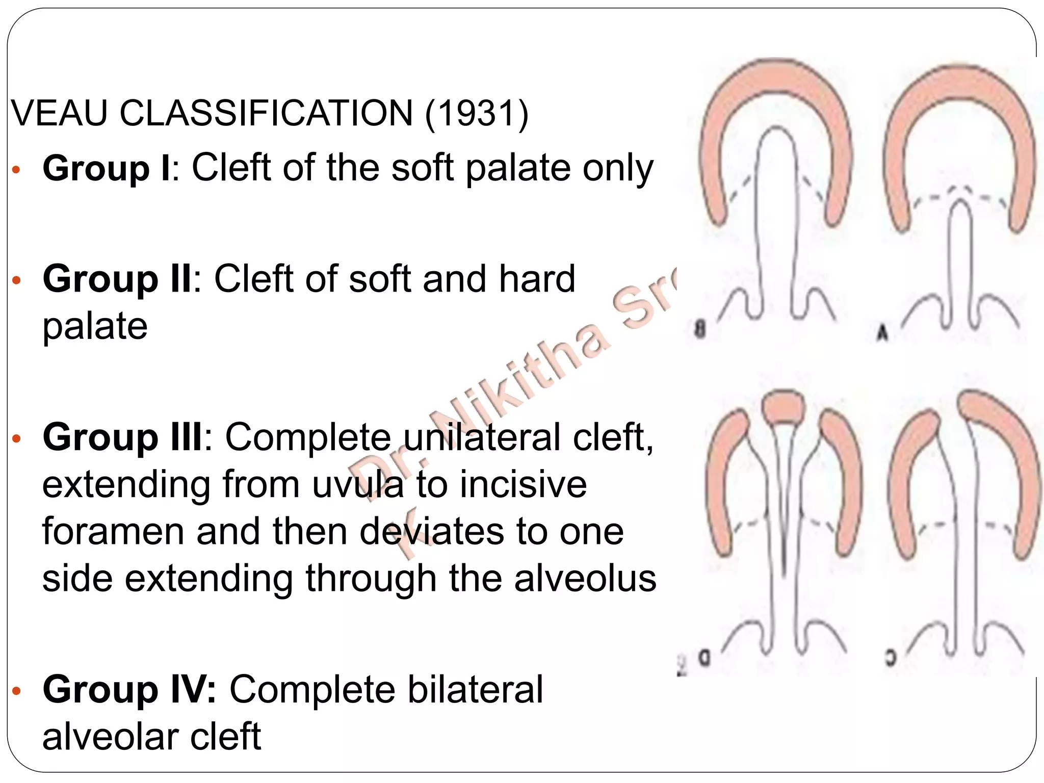 Surgical management cleft lip and palate | PPTX