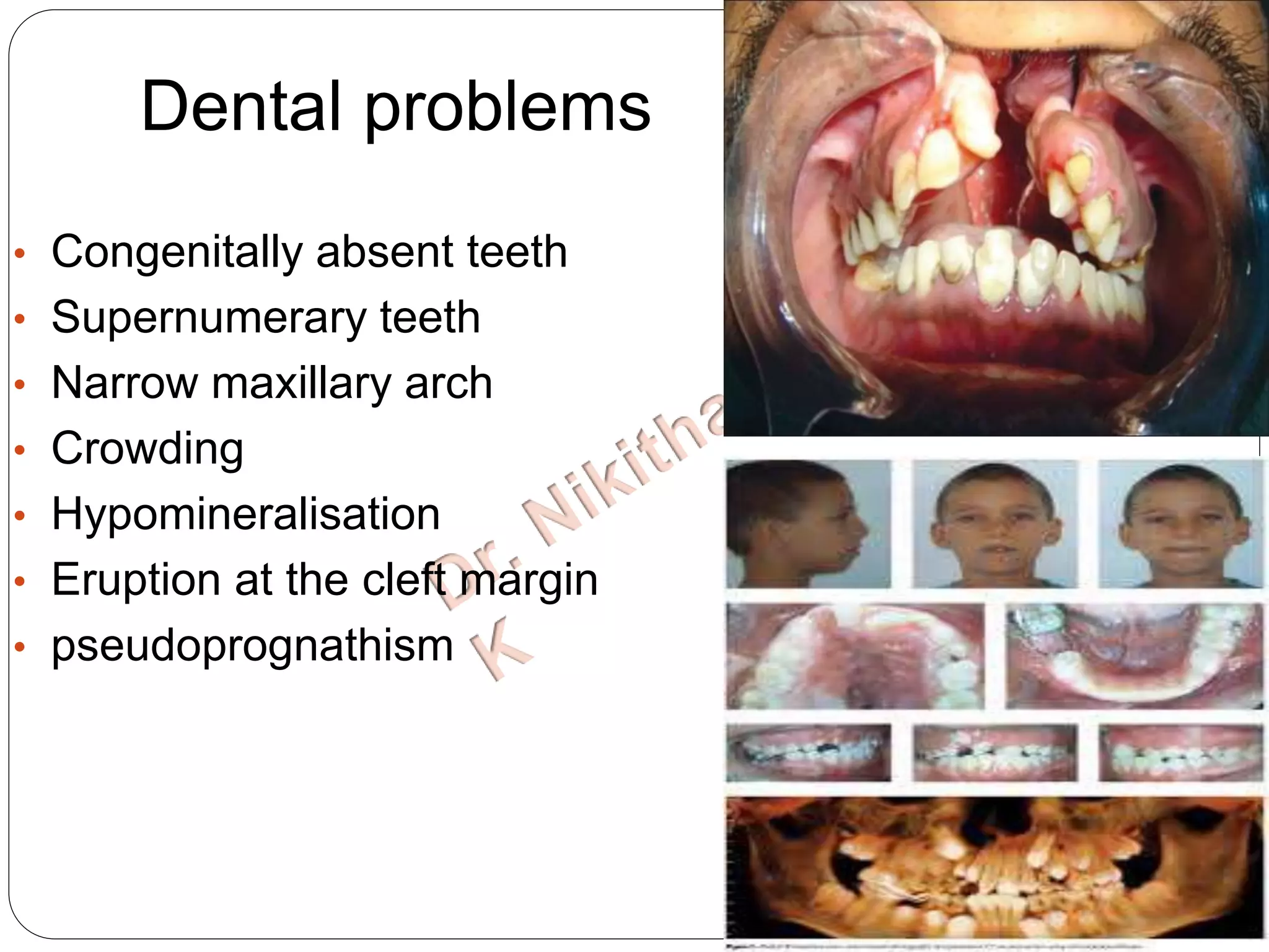 Surgical management cleft lip and palate | PPTX