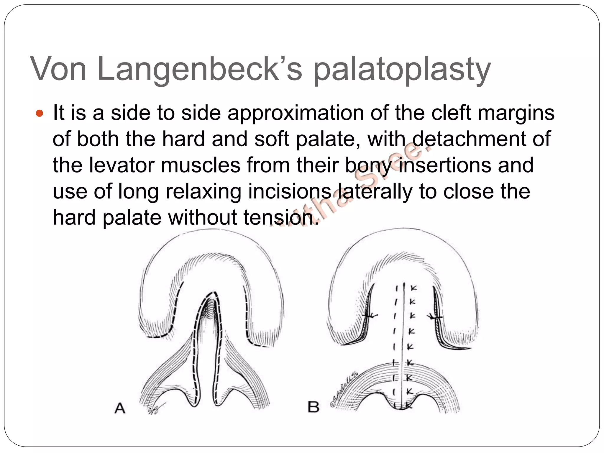 Surgical management cleft lip and palate | PPTX