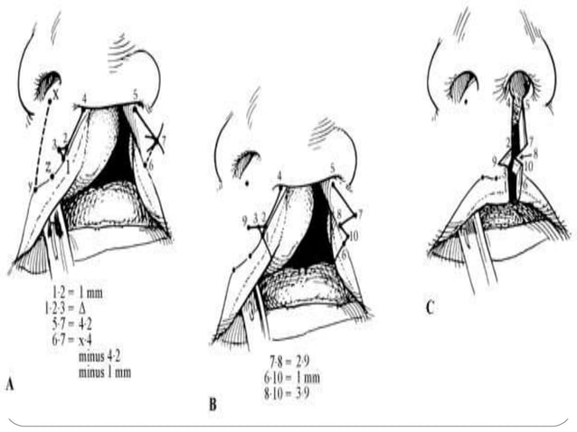 Surgical management cleft lip and palate | PPTX | Ear, Nose and Throat ...