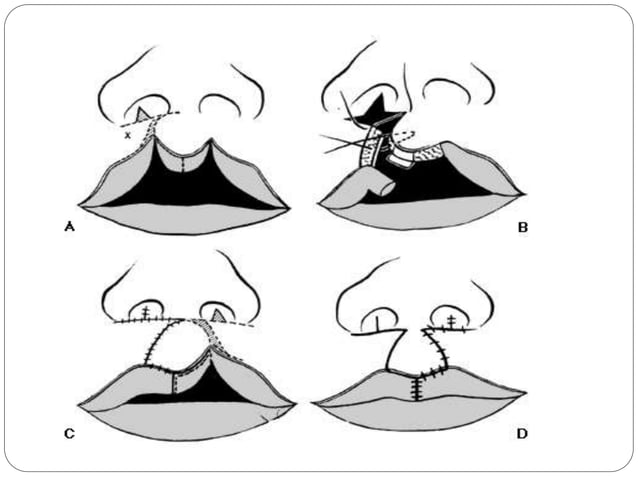 Surgical management cleft lip and palate | PPTX | Ear, Nose and Throat ...