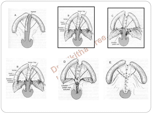 Surgical management cleft lip and palate | PPTX | Ear, Nose and Throat ...