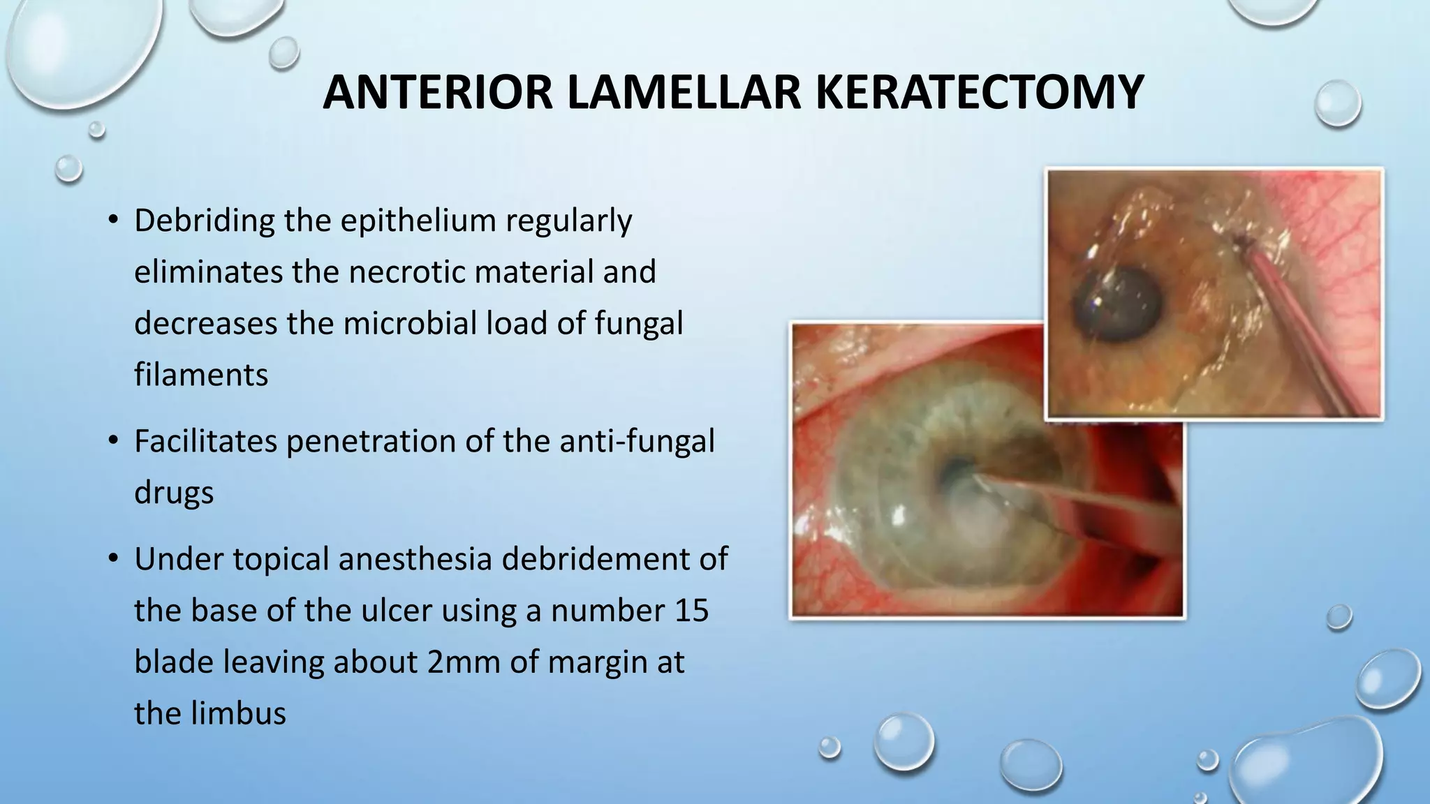 Surgical management of corneal ulcer | PPTX