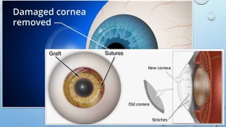 Surgical management of corneal ulcer | PPTX