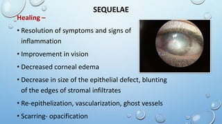 Surgical management of corneal ulcer | PPTX
